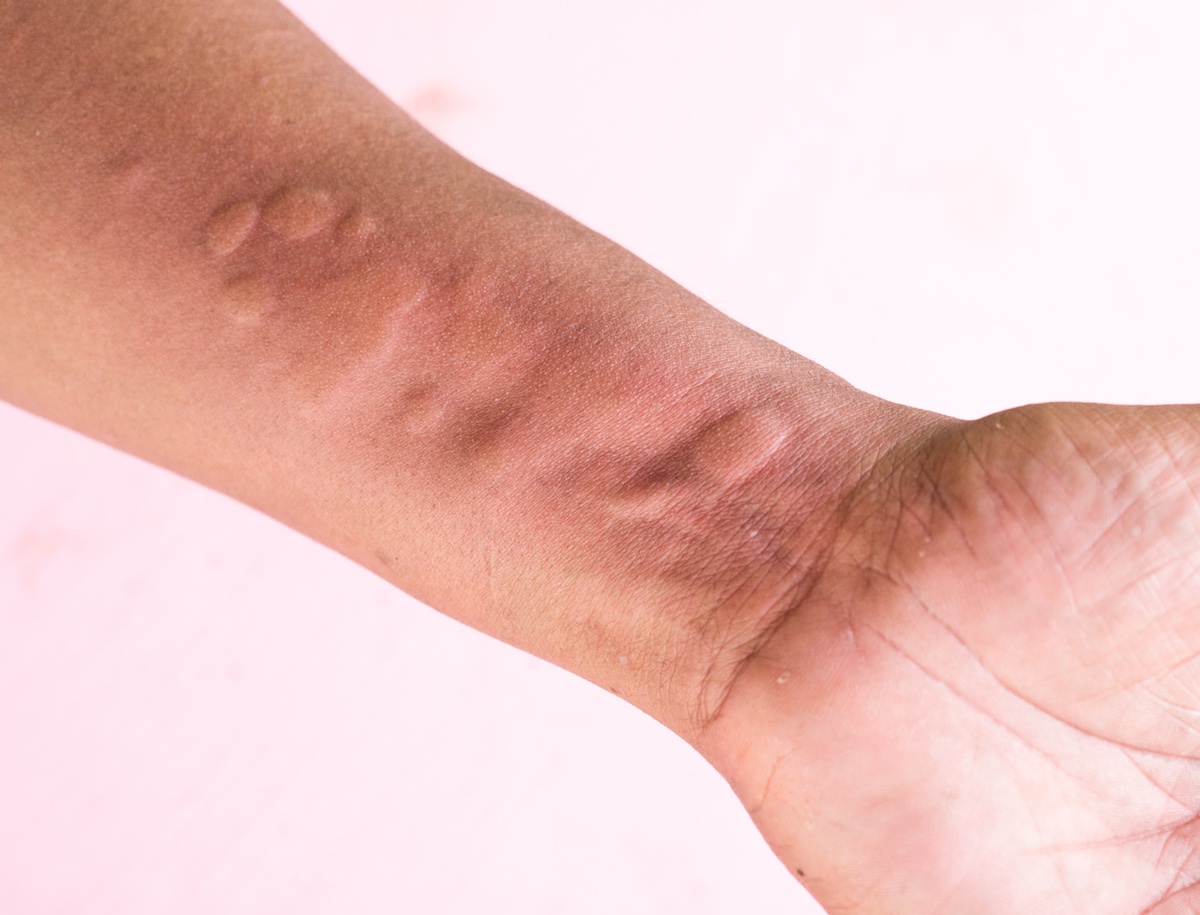 Navigating Airborne Food Allergens Risks Reactions And Precautions